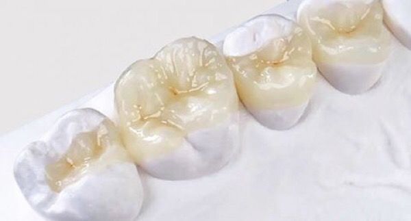 Inlays and Onlays: Advanced Dental Restoration